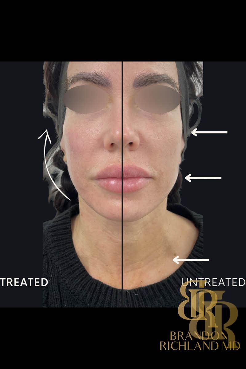 Before & After Forma Facial Procedures in Newport Beach | Dr. Richland
