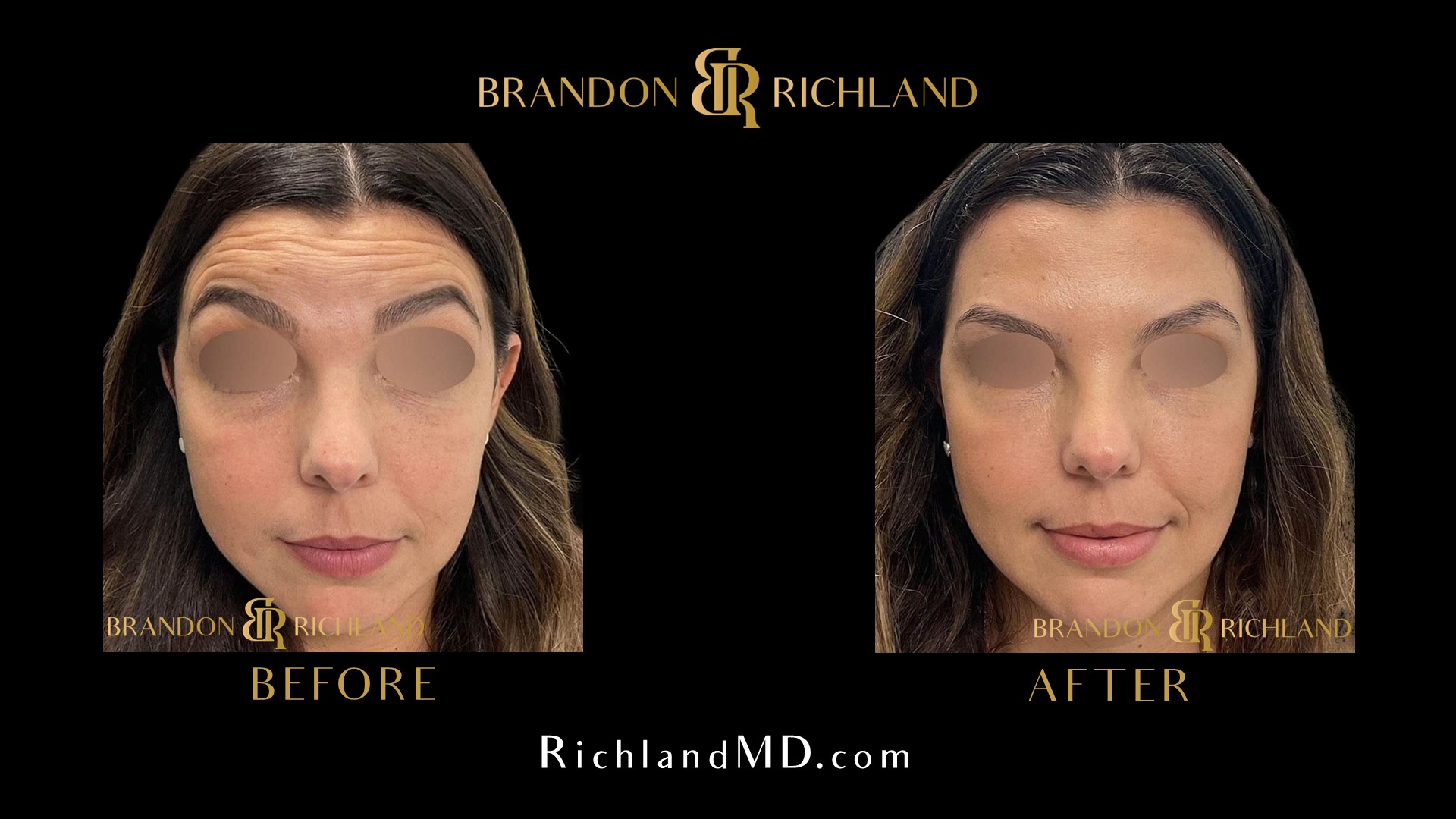 Botox Before and After: Age Defying Transformations | Dr. Brandon ...