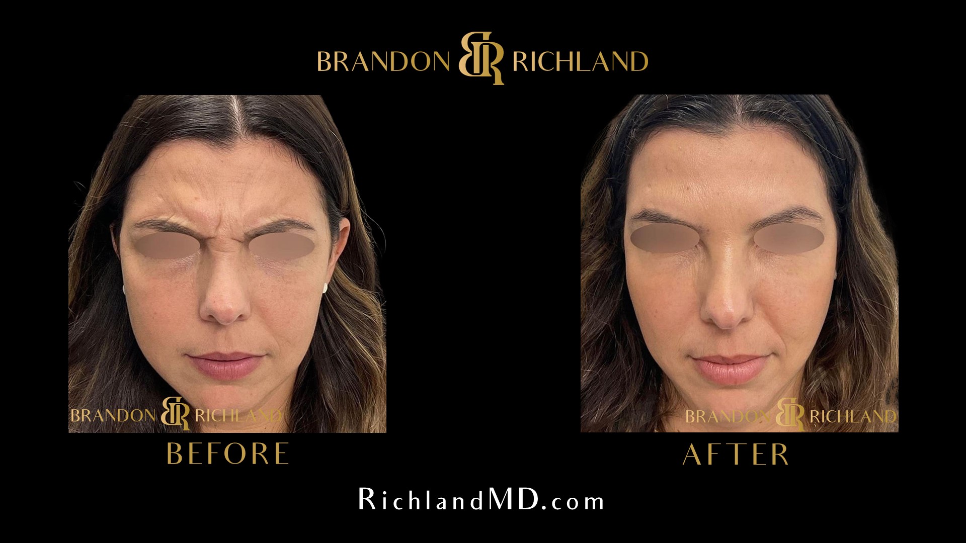Botox Before and After: Age Defying Transformations | Dr. Brandon ...