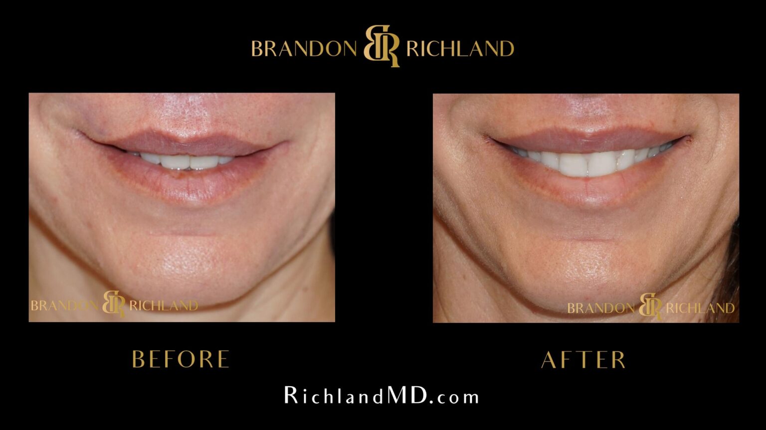Lip Flip Before and After: Luscious Lips | Dr. Brandon Richland, MD