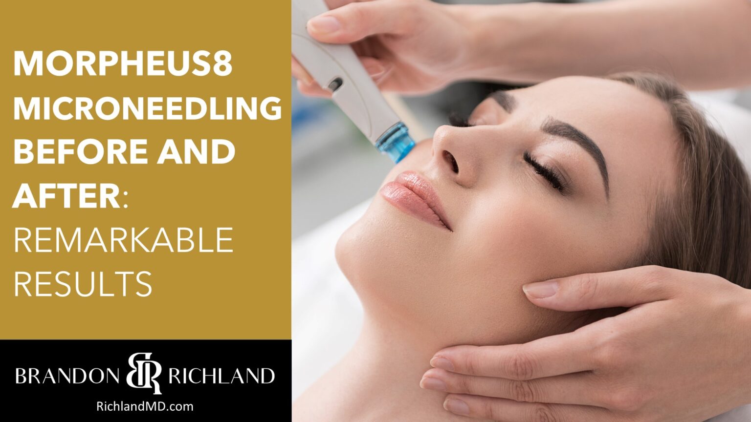 Morpheus8 Microneedling Before and After: Remarkable Results | Dr. Brandon Richland, MD