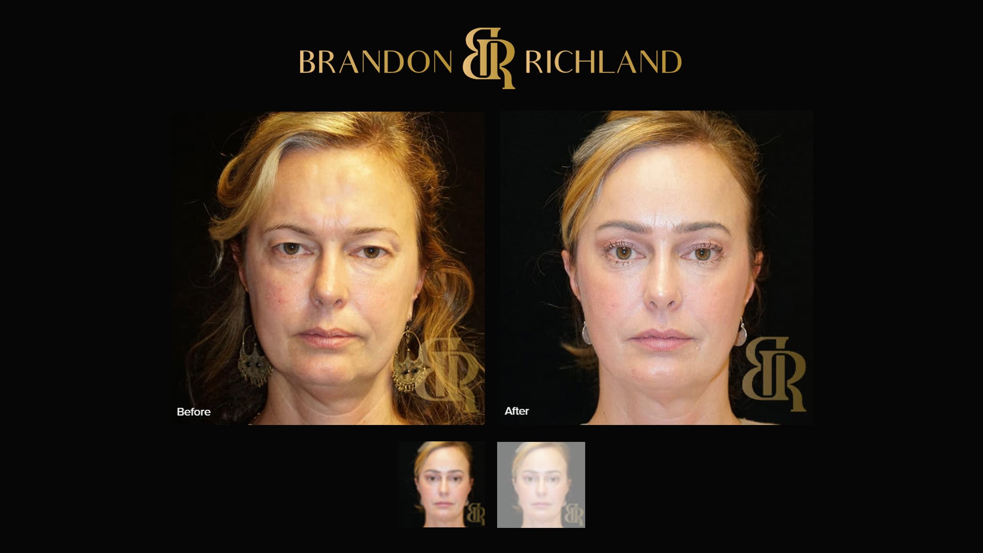 Brow Lift Before and After: What to Expect | Dr. Brandon Richland, MD