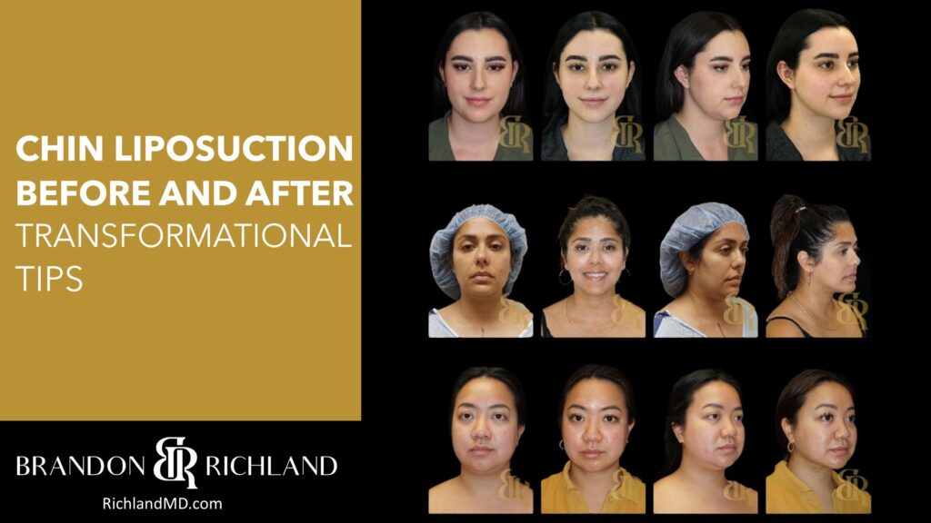 Chin Liposuction Before and After Transformational Tips | Dr. Brandon ...