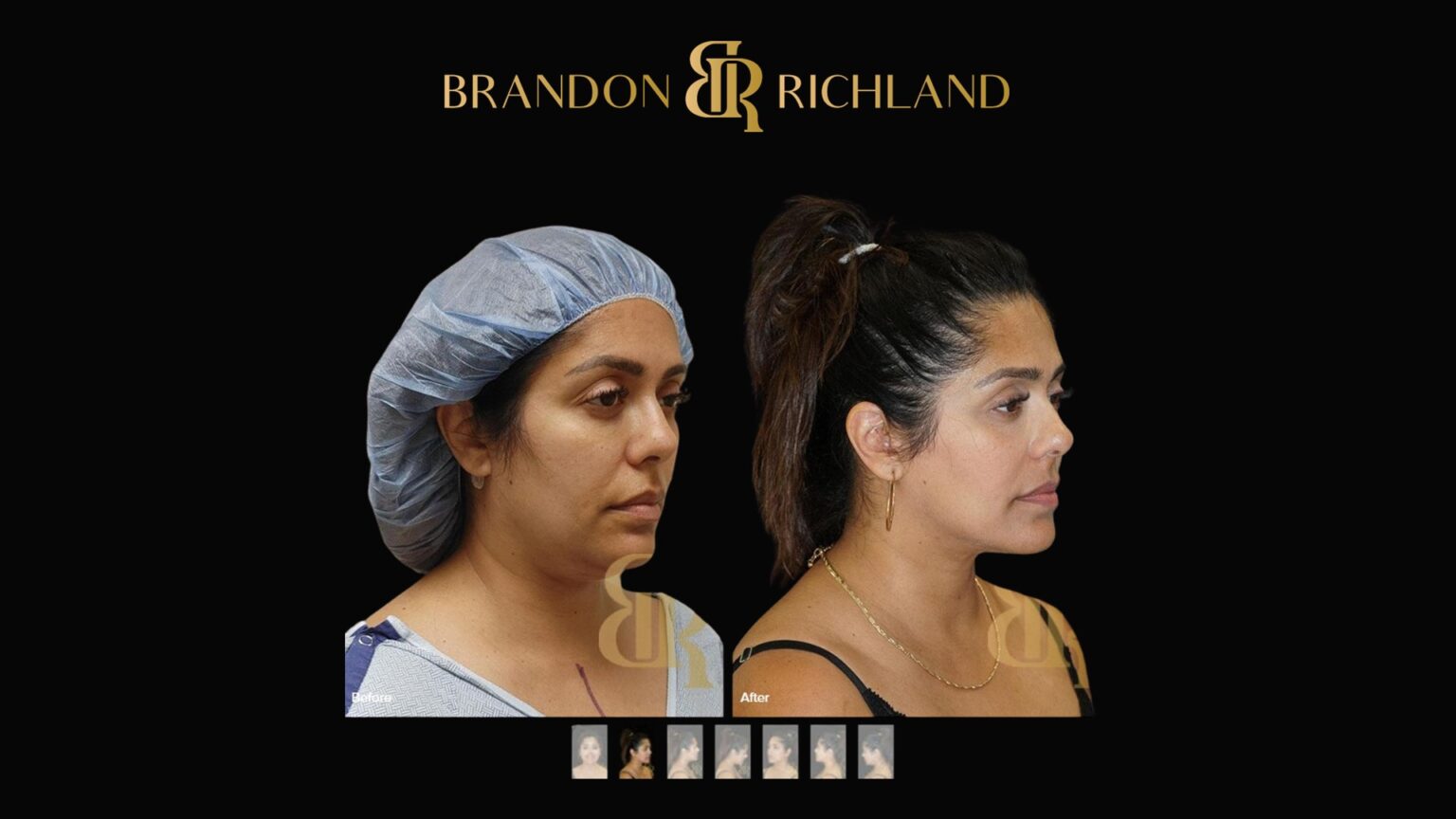 Chin Liposuction Before and After Transformational Tips | Dr. Brandon ...