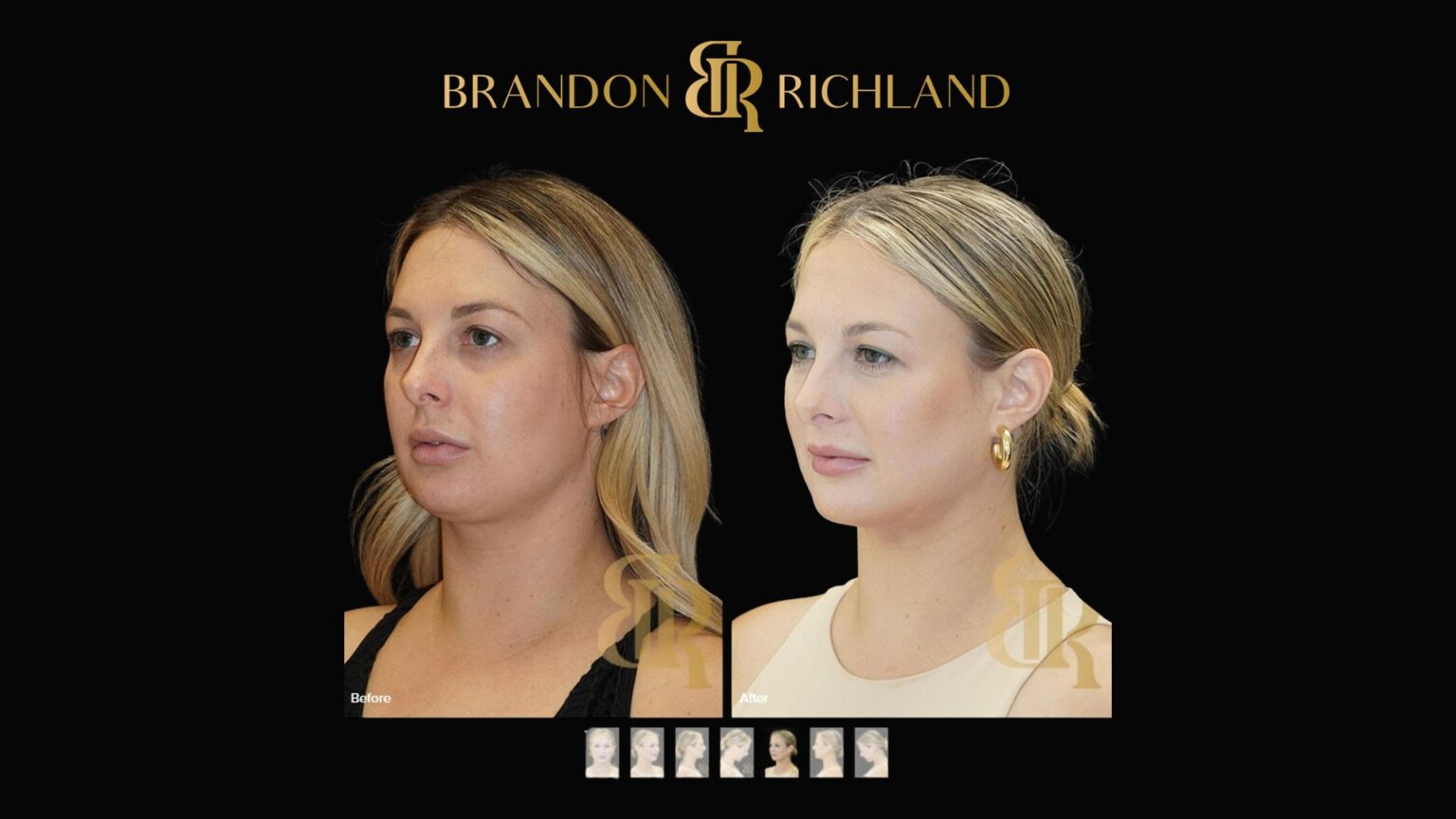 Chin Liposuction Before and After Transformational Tips | Dr. Brandon ...