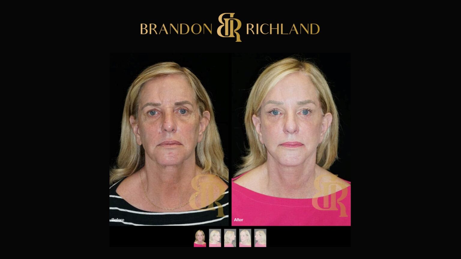 Facelift Before and After Surgery: Facial Transformations | Dr. Brandon Richland, MD