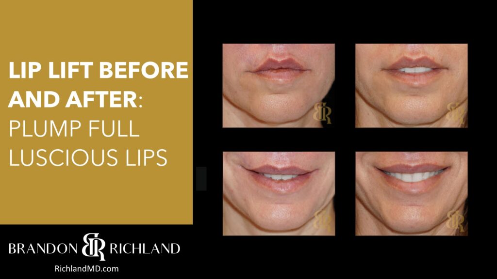 Lip Lift Before and After: Plump Full Luscious Lips | Dr. Brandon ...